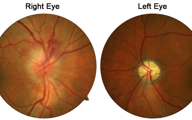 mild optic neuropathy
