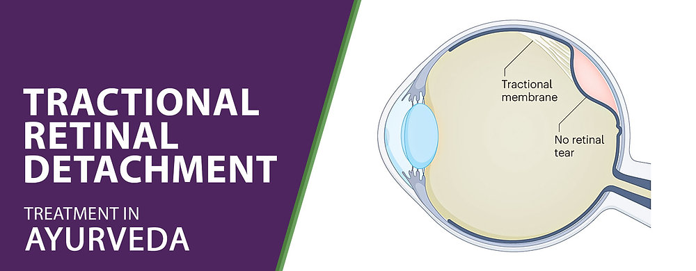 Tractional Retinal Detachment Symptoms Type Causes & Treatment