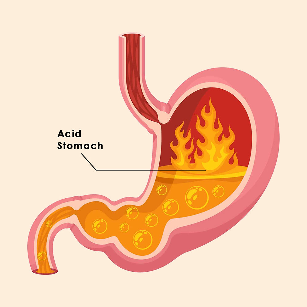 Hyperacidity and Acid Reflex Causes Symptoms & Treatment