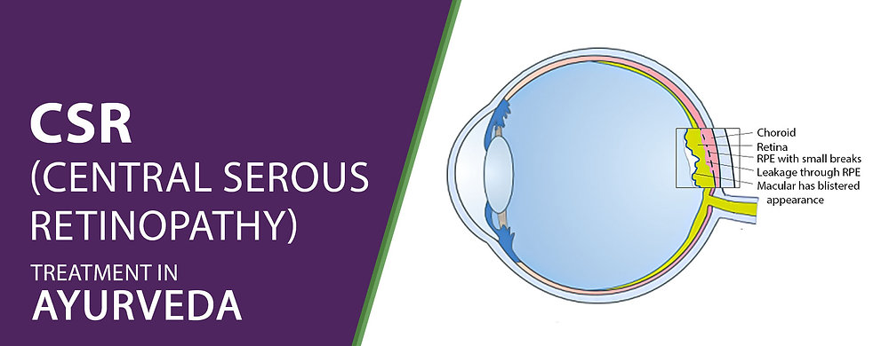 Central Serous Chorioretinopathy (CSCR)