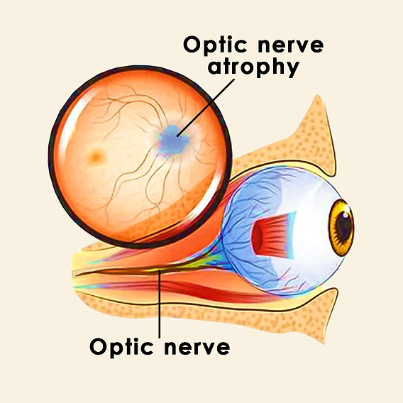 Optic Nerve Atrophy Moran CORE | Optic Atrophy