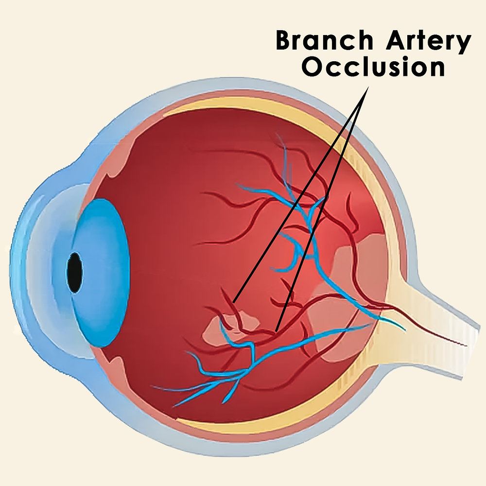 Explore insights into Branch Retinal Artery Occlusion BRAO