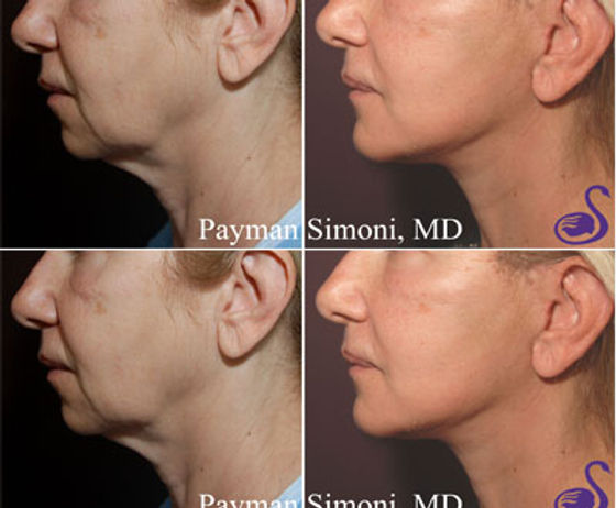 Things to Know About a Rhinoplasty Process