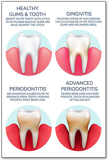 Five Signs of Gum Disease and How to Address Them