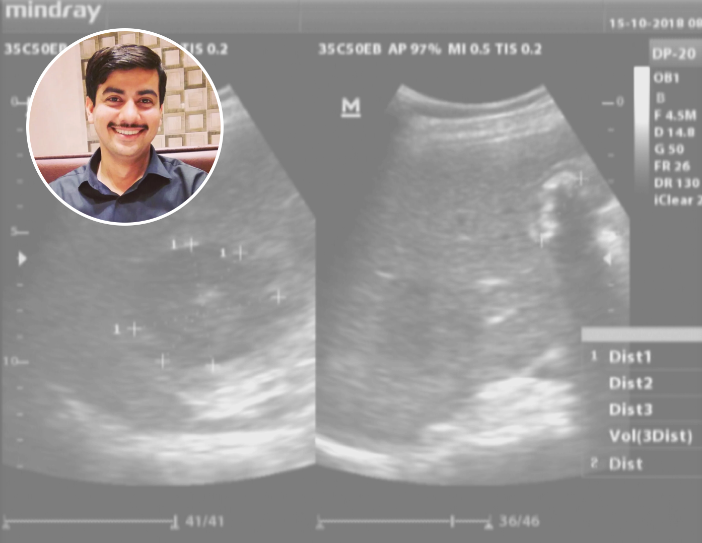 Correlation of Sonographic Appearance of Chronic Liver Disease with ...