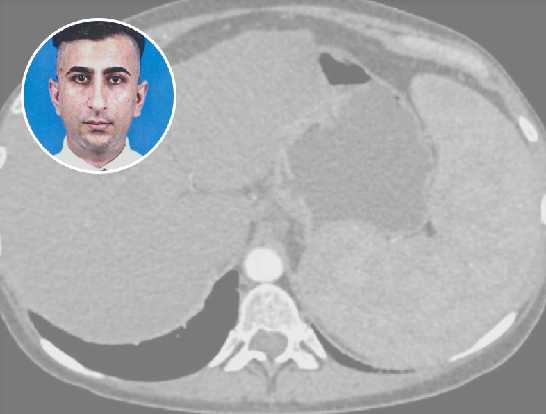 Hypersplenism Caused by Portal Hypertension due to Abnormal Liver Function