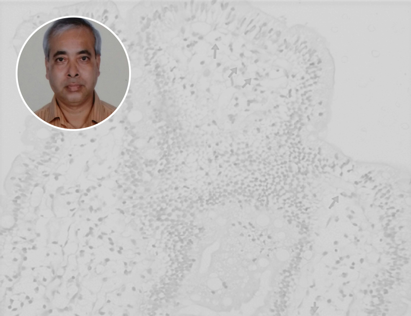 Evaluation of Mast Cell and Eosinophil Count in Duodenal Mucosa- A ...