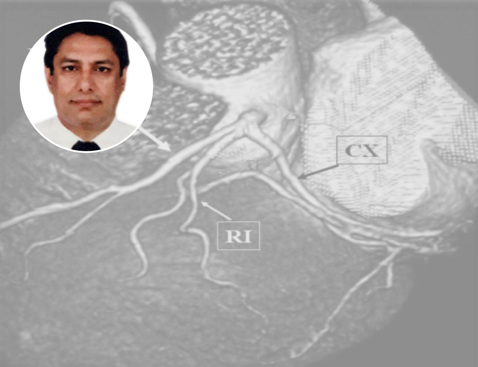Prevalence of Coronary Variants and Anomalies Detected on Computed ...