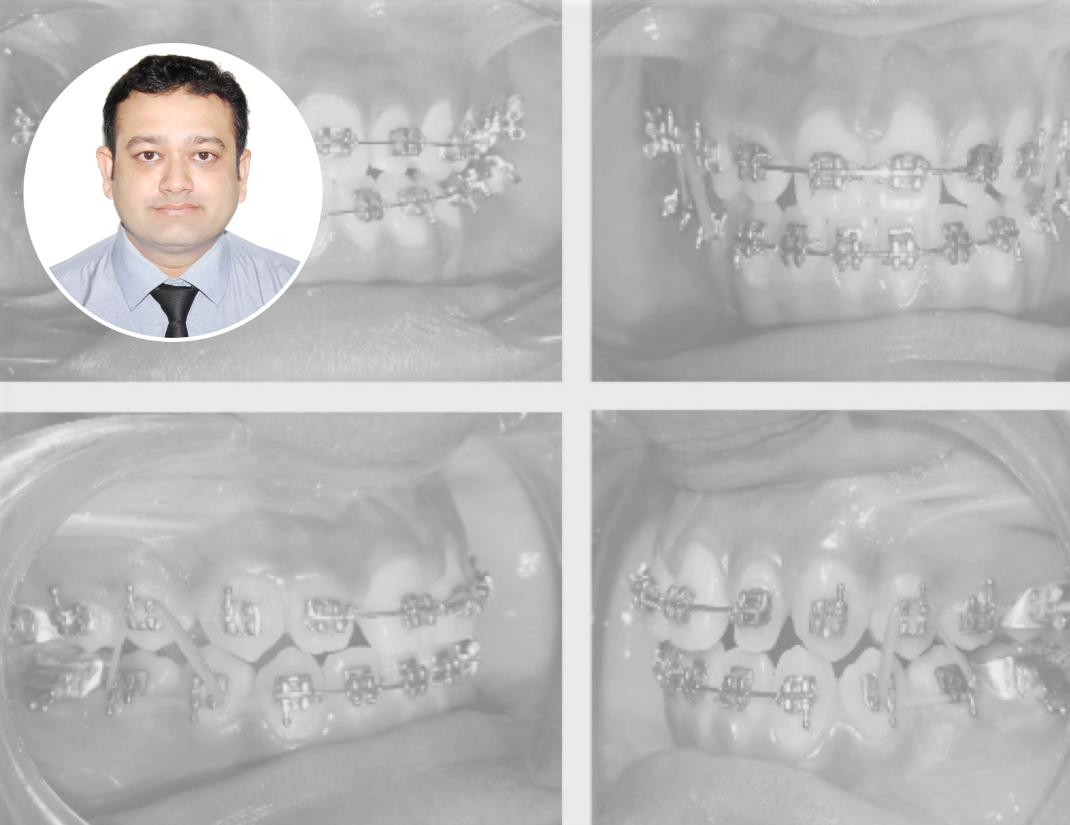 Treating an Orthodontic Case of Midline Diastema with High Frenal ...