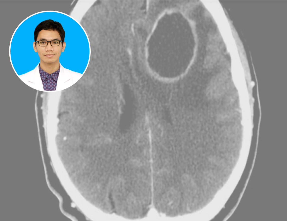 Anesthetic Management in Patient with Suspected Brain Abscess, Atrium ...