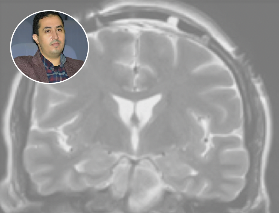 Calvarial Metastasis with Dural Sinus Invasion: A Case Report