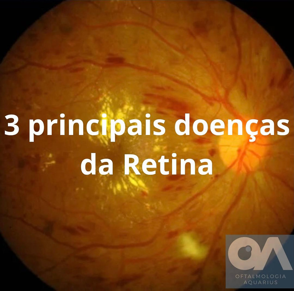 3 principais doenças da Retina