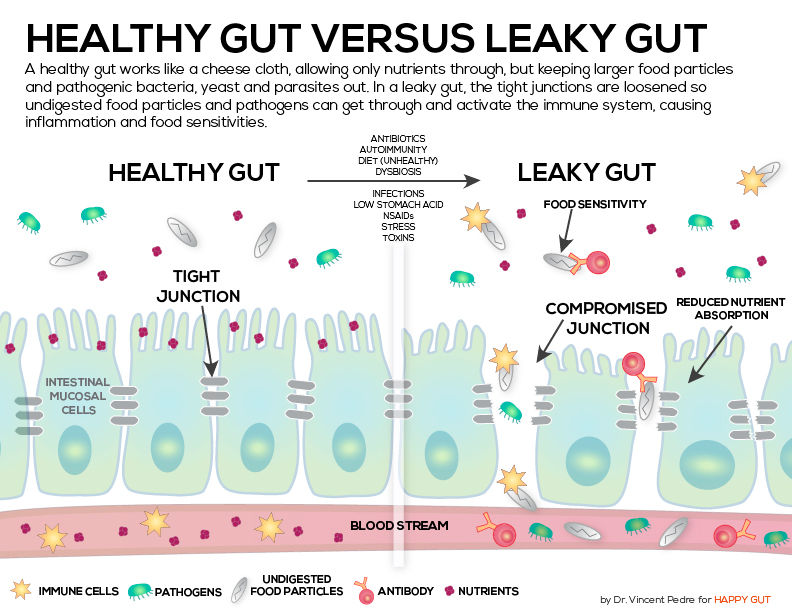 Leaky Gut- The Basics Revisited & The Science To Support It