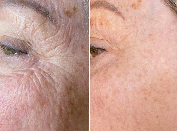 The First Plasma Pen Specialist in Seattle Area that offers all 8 types ...