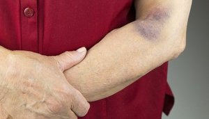 Risk Factors of Elderly Bruising