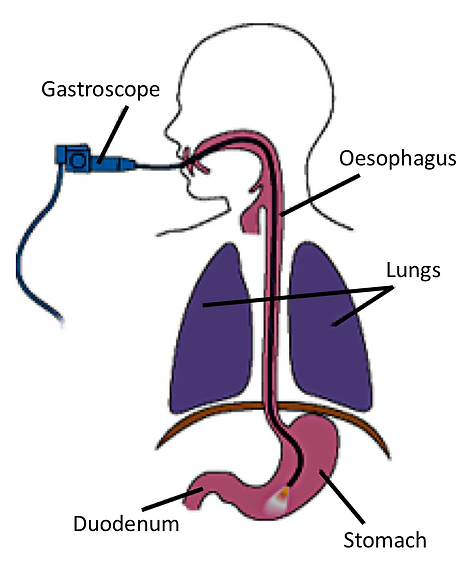 GASTROSCOPY | Surrey Gastro Clinic