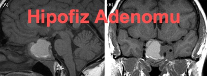 Hipofiz Adenomu Belirtileri, Tedavisi | Dr. Tamer Tekin