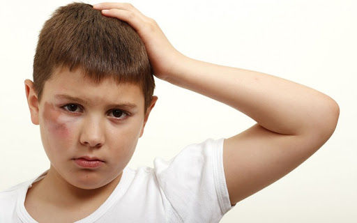 Head Injury in Children