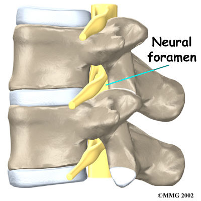 Neural Foramen - Neural Foraminal Narrowing