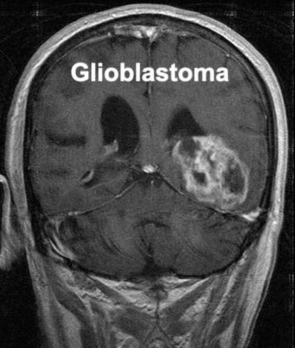 Glioblastom