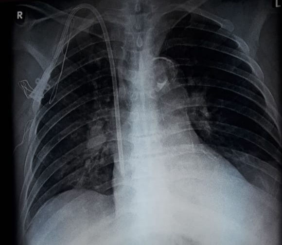 CATETERES PARA HEMODIALISIS