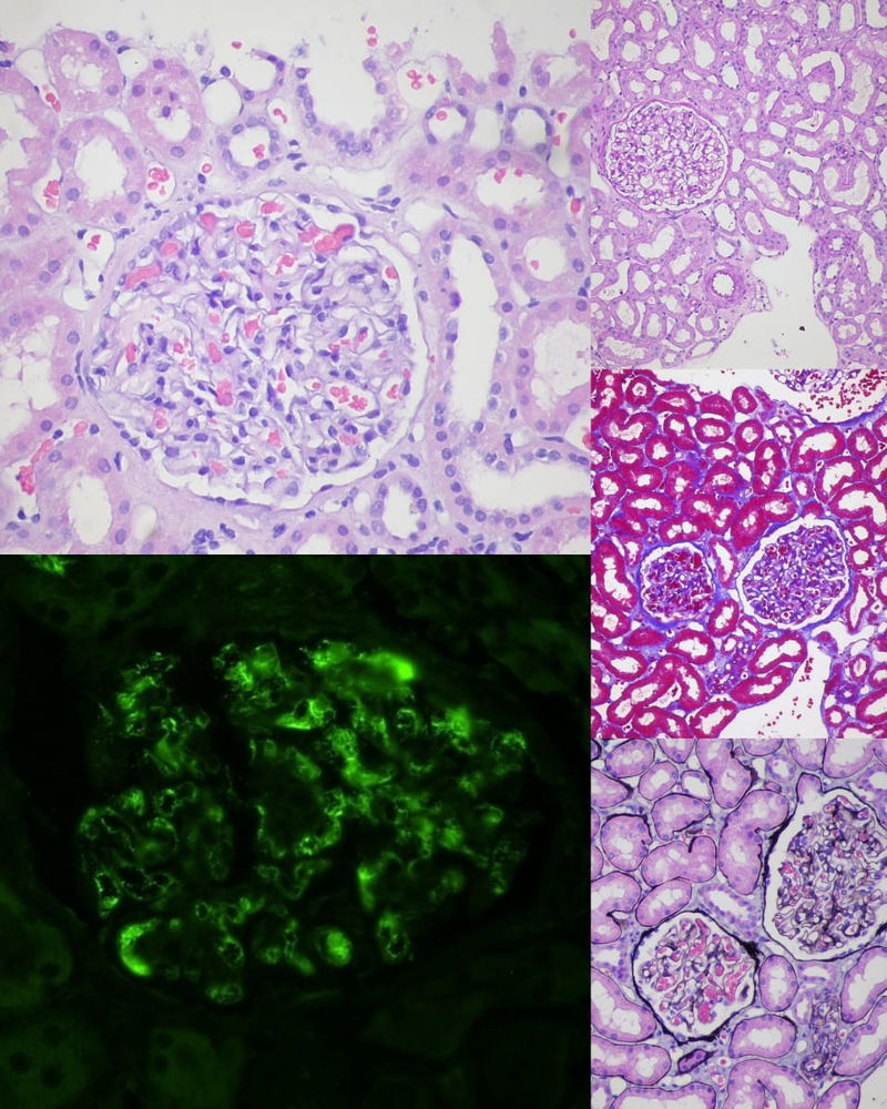 NEFROPATIA POR IGA (ENFERMEDAD DE BERGER): INFORMACION BASICA