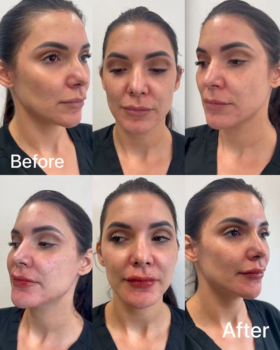 Best Facial Before and After Pictures | Queen Aesthetics