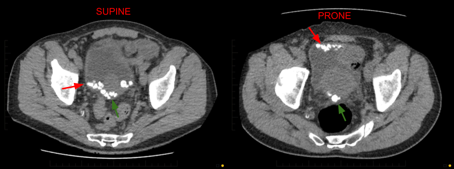 CT KUB - Supine vs Prone