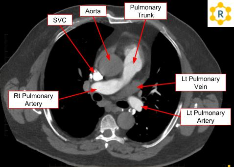 Getting the perfect CTPA