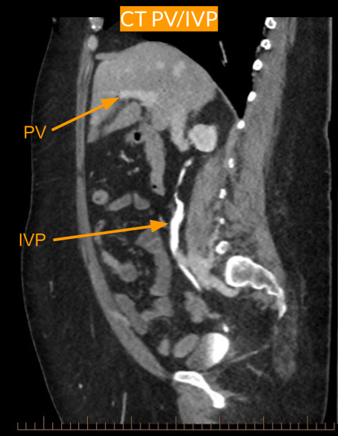 How to perform a Split Bolus CT Scan