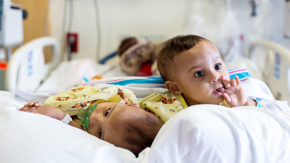 The Birth of Conjoined Twins