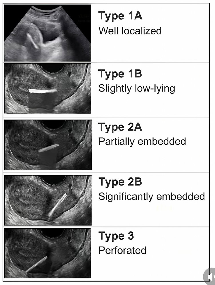IUCD Ultrasound Position Guide