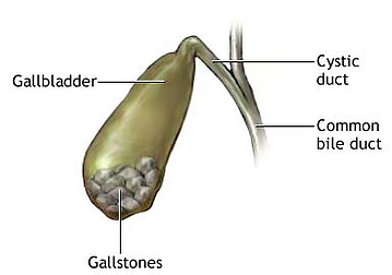 Gallbladder Stones | Singapore | SILS Surgery Singapore