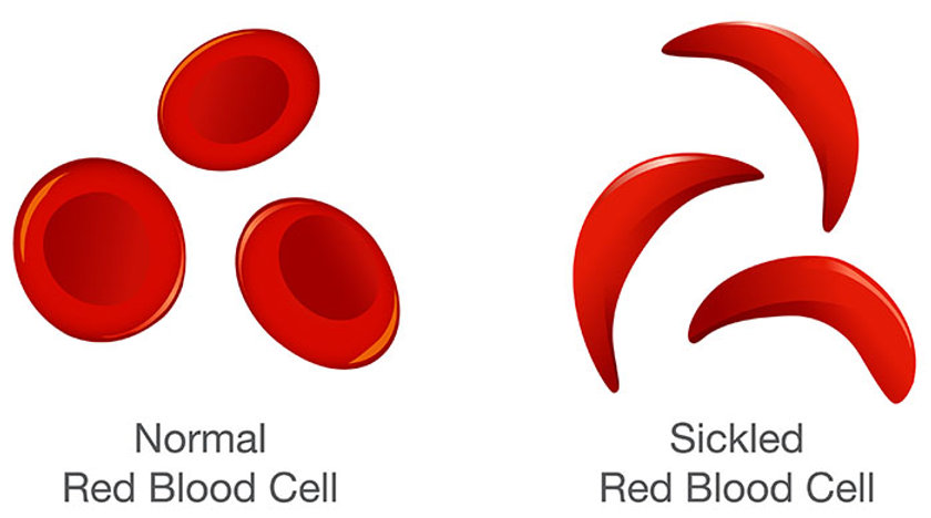 Sickle Cell Disease and the Sickle Cell Trait: A Simplified Explainer