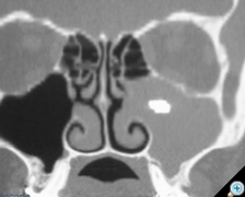 méatotomie moyenne et inférieure | monsite-1