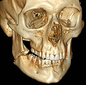broken zygomatic bone
