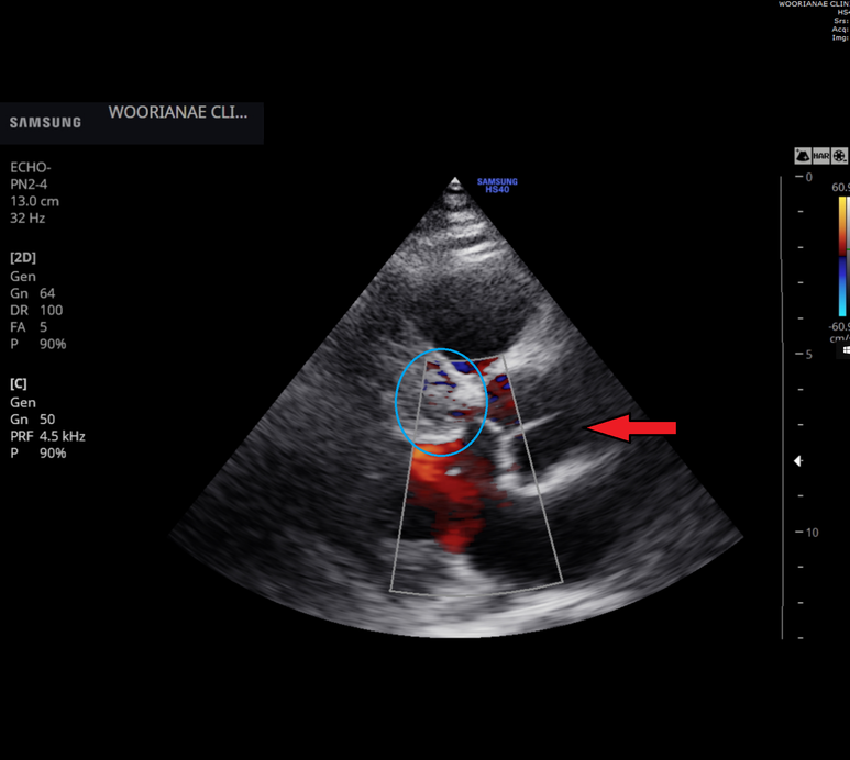 심장 초음파에서 관찰된 정상 변이, sigmoid septum, lambl's excrescences (램블 증식물)
