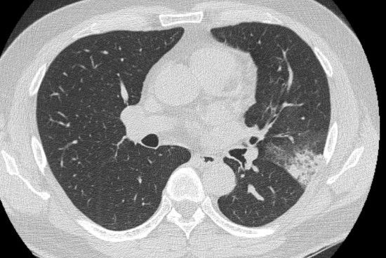 객혈 사례, currant jelly sputum, 증상은 만성 기관지염이나 영상학적 폐렴(klebsiella pneumonia ...