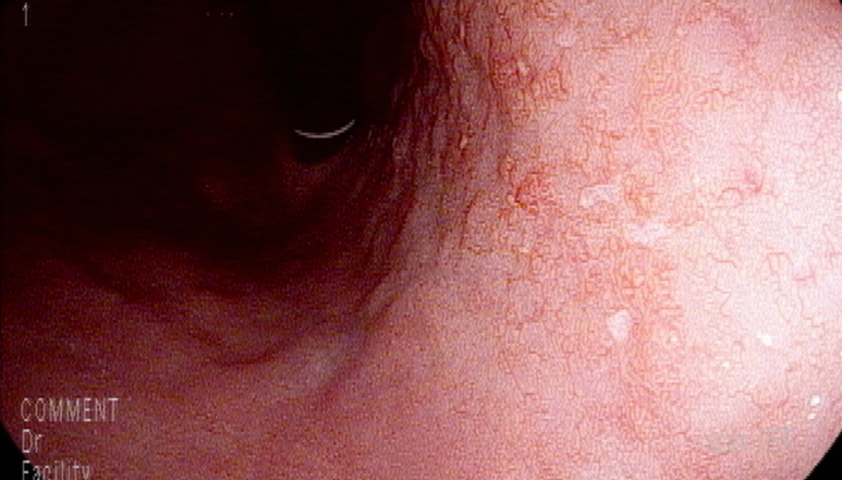 위 말트림프종 (MALToma) 의증