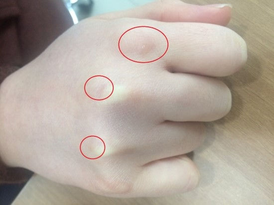 Russell's sign, Bulimia Nervosa, 신경성 폭식증의 피부 소견