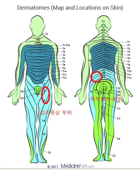 엉덩이~허리 대상 포진 후 허벅지 앞쪽 사타구니쪽 감각증상, 주로 저녁, 잘때 쓰라리고 따갑다, L3 dermatome