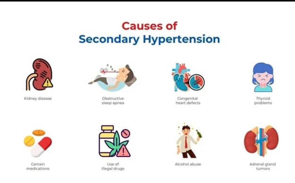 What is high blood pressure (hypertension)? High blood pressure, also ...