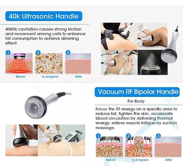 Body Sculpting: Radio Frequency & Vacuum | Light Power Spa