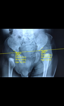Acetabular Index App Orthopractis.com hip i-phone infant index ,itune