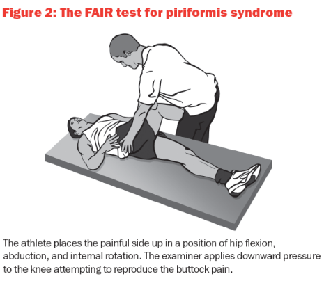 Piriformis syndrome: the causes, diagnosis and treatment of this common ...