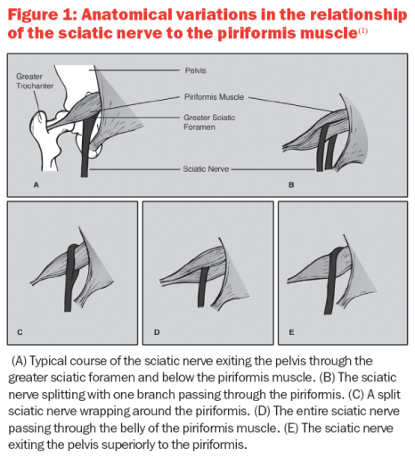 Piriformis syndrome: the causes, diagnosis and treatment of this common ...
