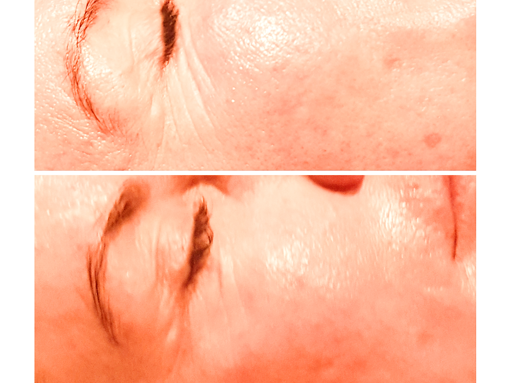 Microneedling for Hyperpigmentation