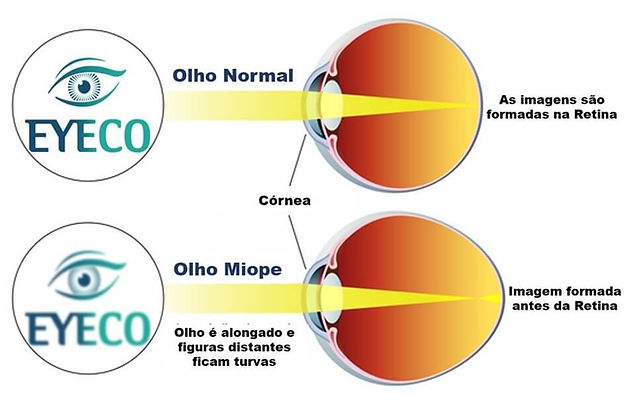 Miopia Leve | atelier-yuwa.ciao.jp