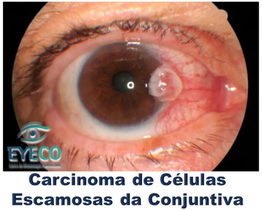 Carcinoma de Células Escamosas da Conjuntiva (CEC): Entenda os Sintomas, Diagnóstico e Tratamentos
