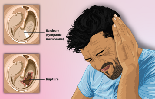 Understanding Ruptured Eardrums: Causes and How to Prevent Them